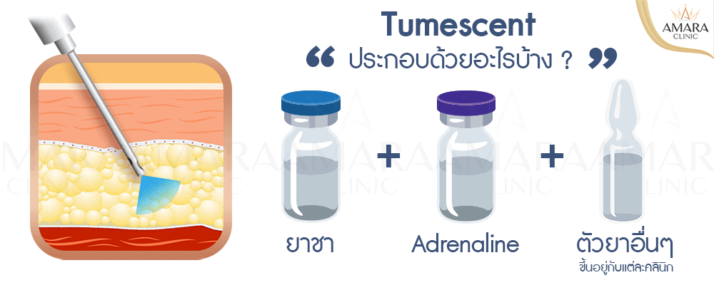 tumescent - ดูดไขมัน เติมไขมัน Amara Liposuction Center (เอมาร่า คลินิก ...