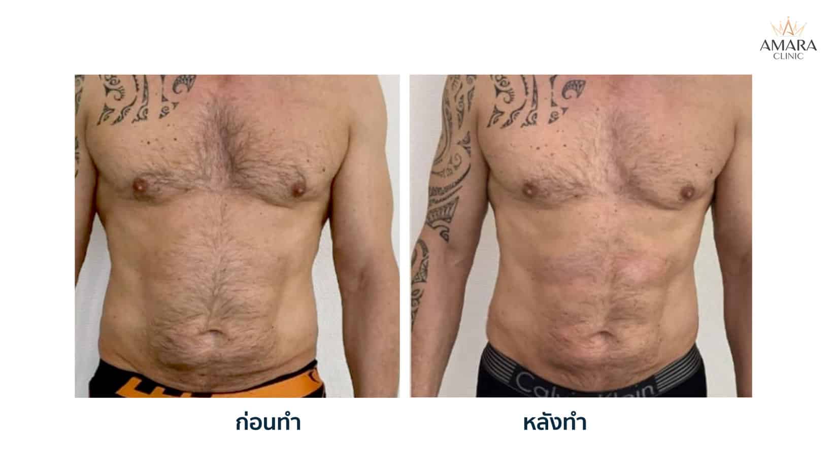 Tesla Former นวัตกรรมบิ้วท์กล้ามเนื้อ เบิร์นไขมัน ไม่ต้องง้อยิม!