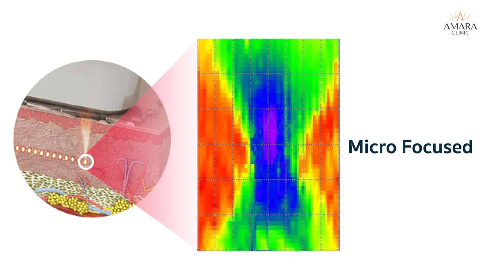 Ultraformer III ยกกระชับได้ดีกว่าไฮฟู่ถึง 5 เท่า!